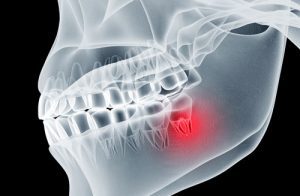 Dientes incluidos, qué son, cómo se detectan y tratan