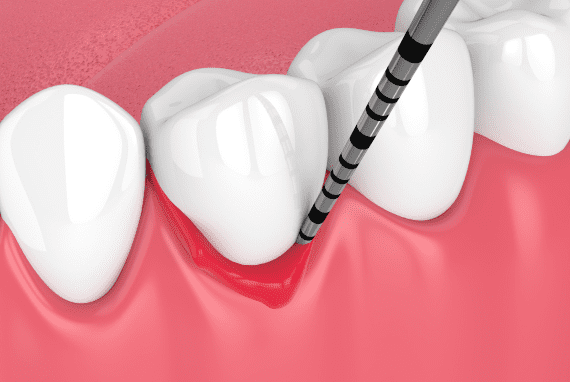 ¿Qué es un raspado dental y por qué podrías necesitarlo? ¿Qué es un raspado dental y por qué podrías necesitarlo?