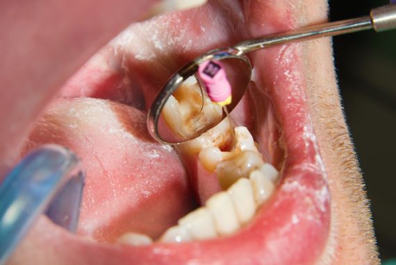 Reendodoncia: ¿cuándo es necesaria y qué esperar?
